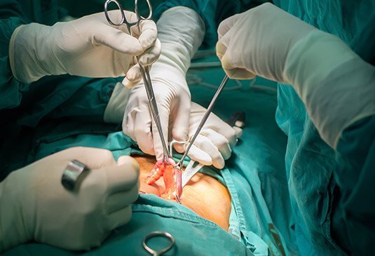 Appendicitis Surgery Cost Yashoda Hospitals